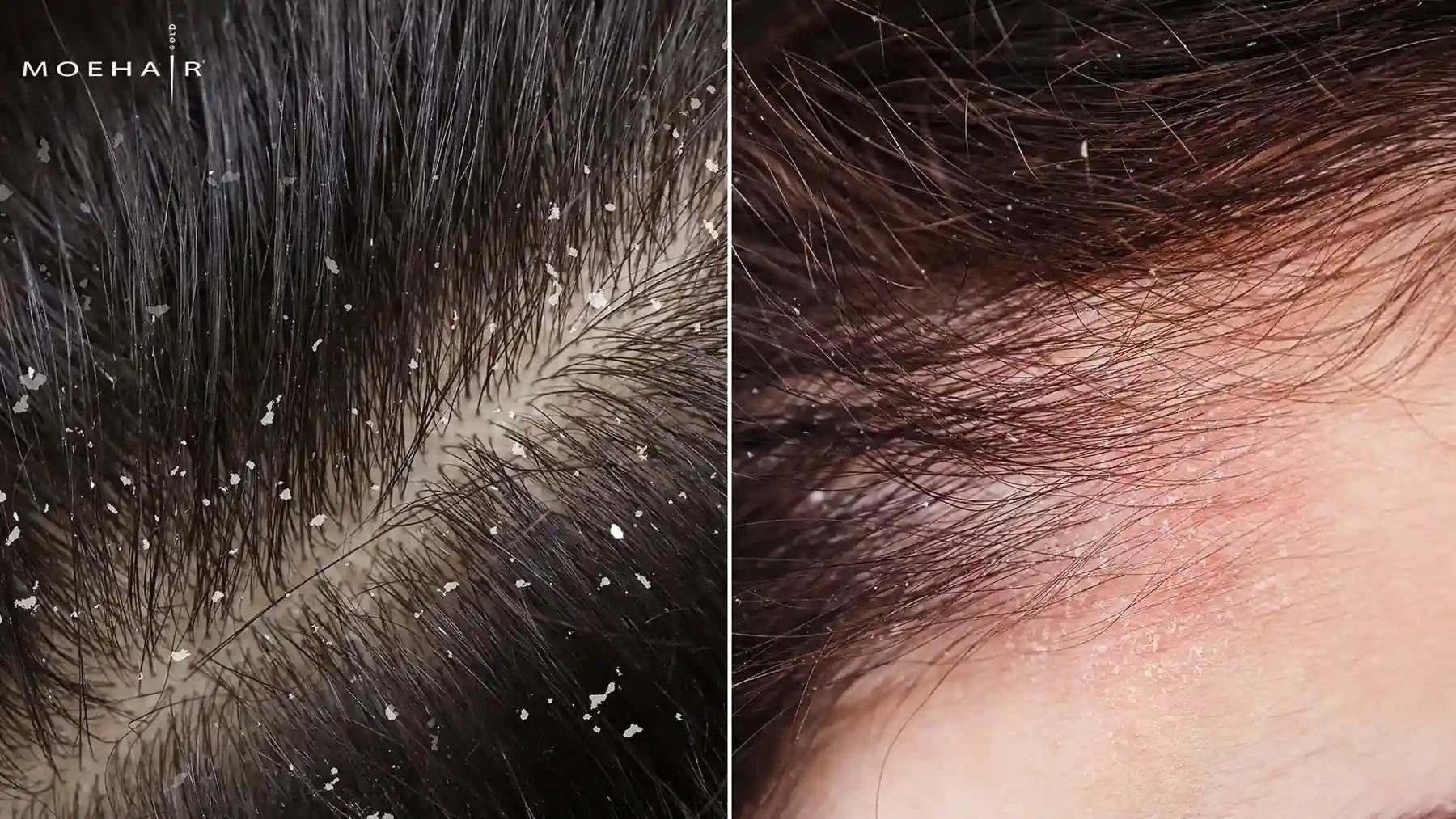 Dandruff Flakes Vs Dry Scalp Flakes